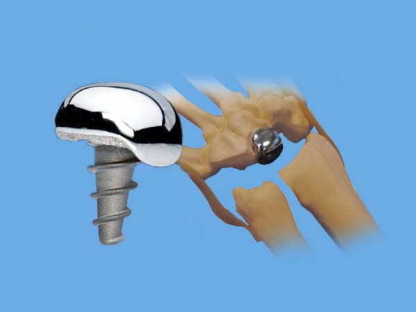 Arthrosurface WristMotion® – Obex