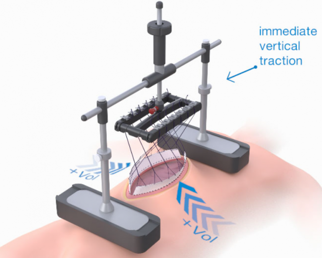Fasciotens® Abdominal Wall Solutions – Obex